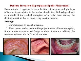 Denture Induced Fibrous Hyperplasia
