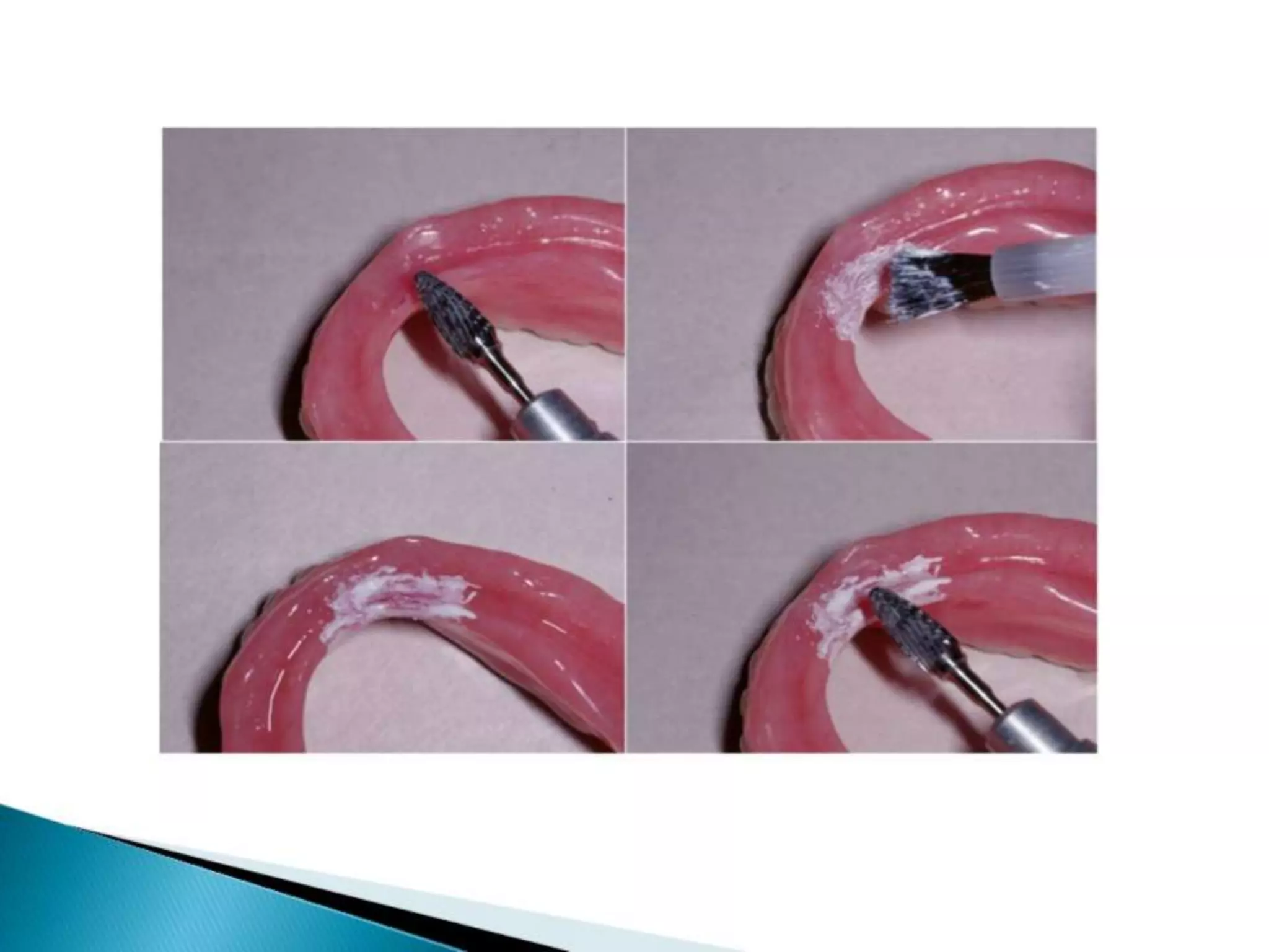 Post Insertion Problems In Complete Denture Part I PPTX post-insertion-problems-in-complete-denture-part-i-pptx