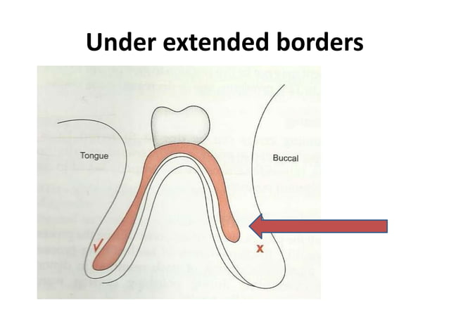 Post insertion problems in complete dentures | PPTX | Dental Health ...