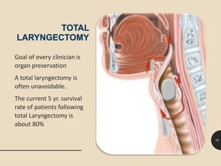 Post laryngectomy voice rehabilitation education in Pakistan | PPTX
