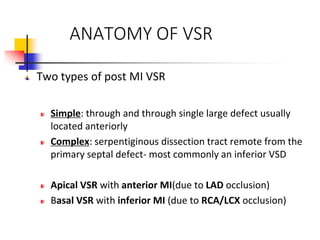 Post MI Ventricular Septal Rupture | PPT
