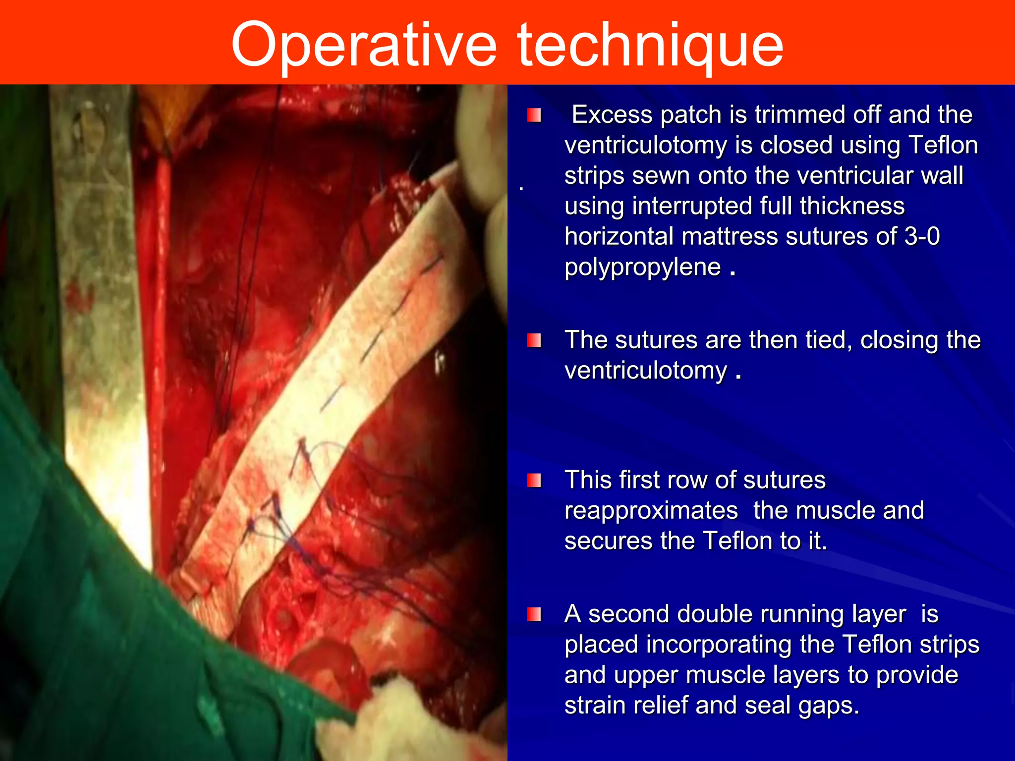 Post Myocardial infarction vsd repair by infarct exclusion technique | PPT