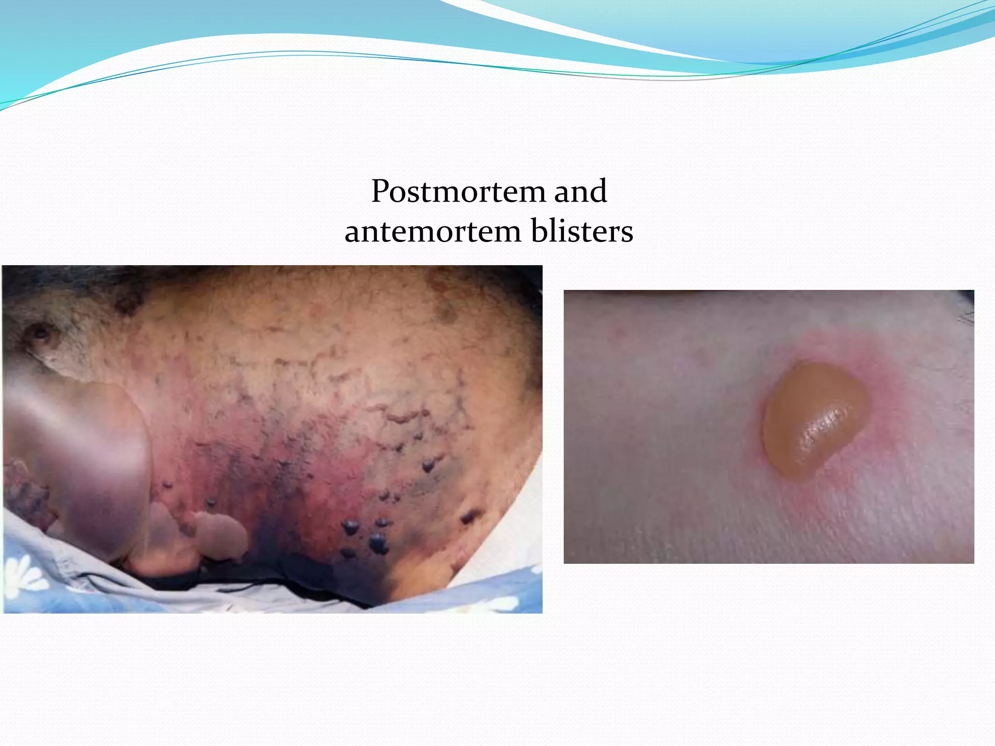 Postmortem artefcts | PPTX