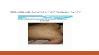 POST MORTEM ARTEFACTS(forensic medicine) | PPTX