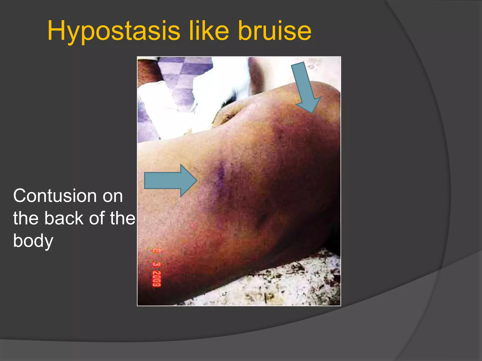 Postmortem artifacts - a Forensic perspective | PPTX