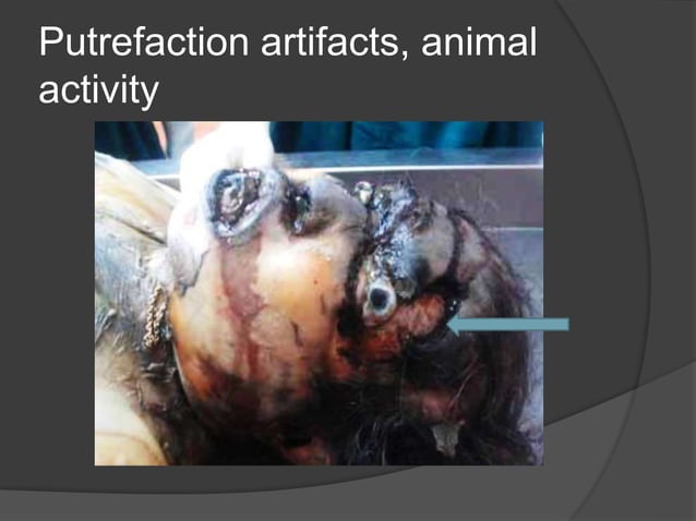 Postmortem artifacts - a Forensic perspective | PPTX | First Aid | Injuries