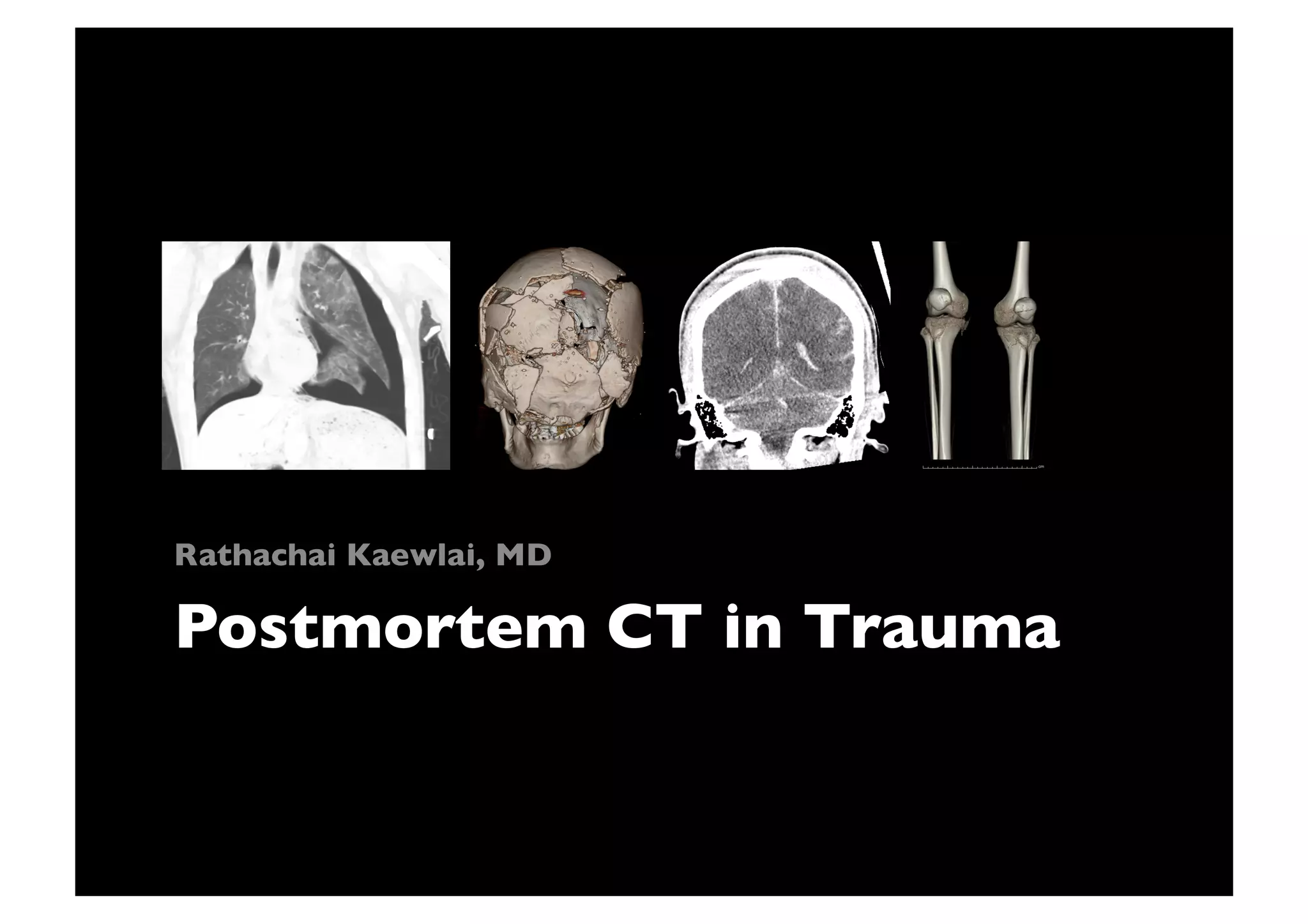 Postmortem CT (PMCT) | PDF