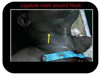 Postmortem Injury or Antemortem ligature mark new (002).ppt