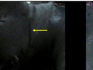 Postmortem Injury or Antemortem ligature mark new (002).ppt