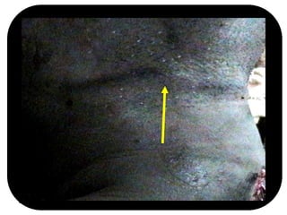 Postmortem Injury or Antemortem ligature mark new (002).ppt