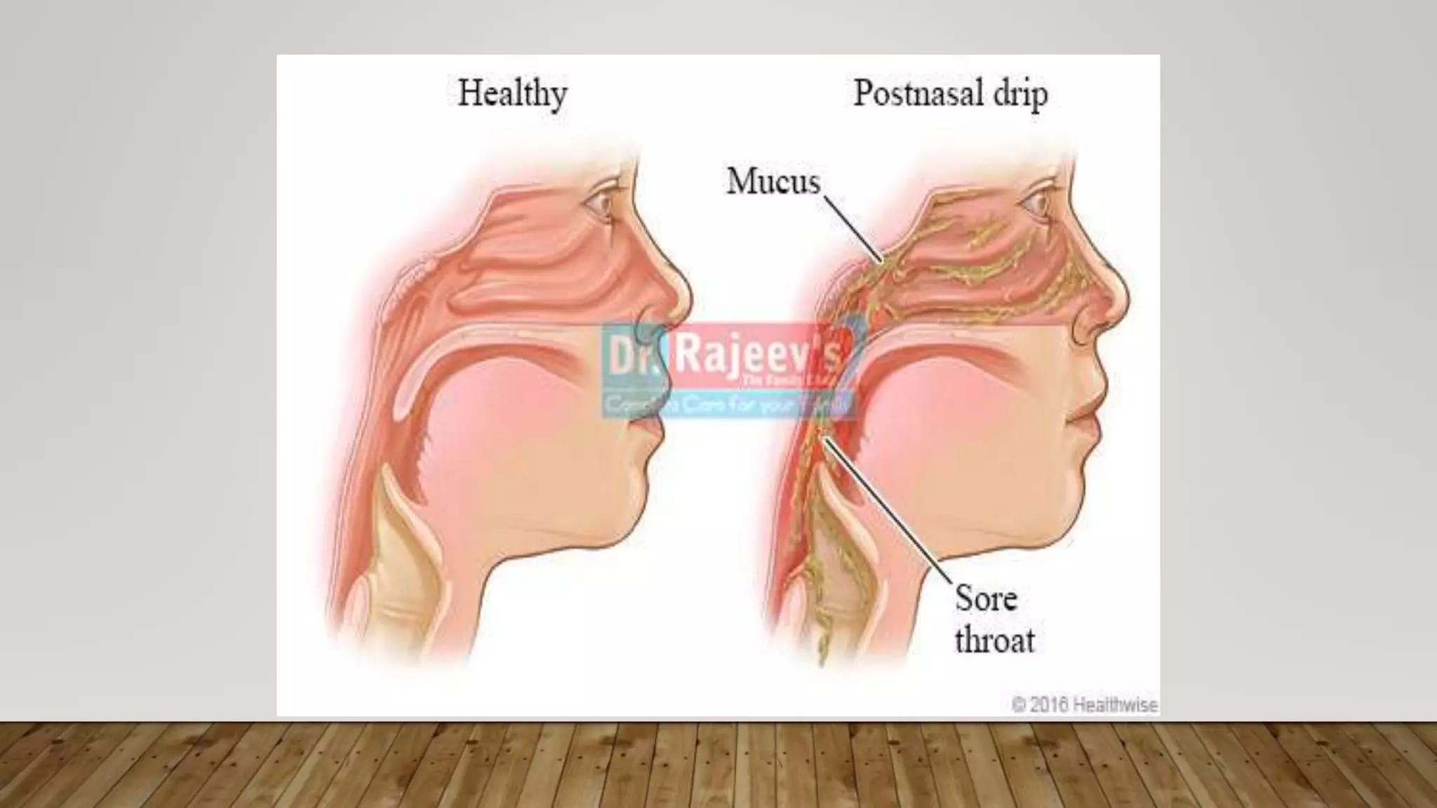 Post nasal drip | PPTX