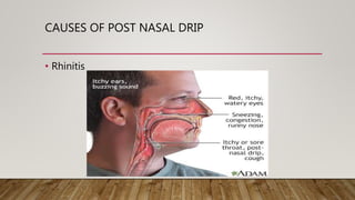 Post nasal drip | PPTX
