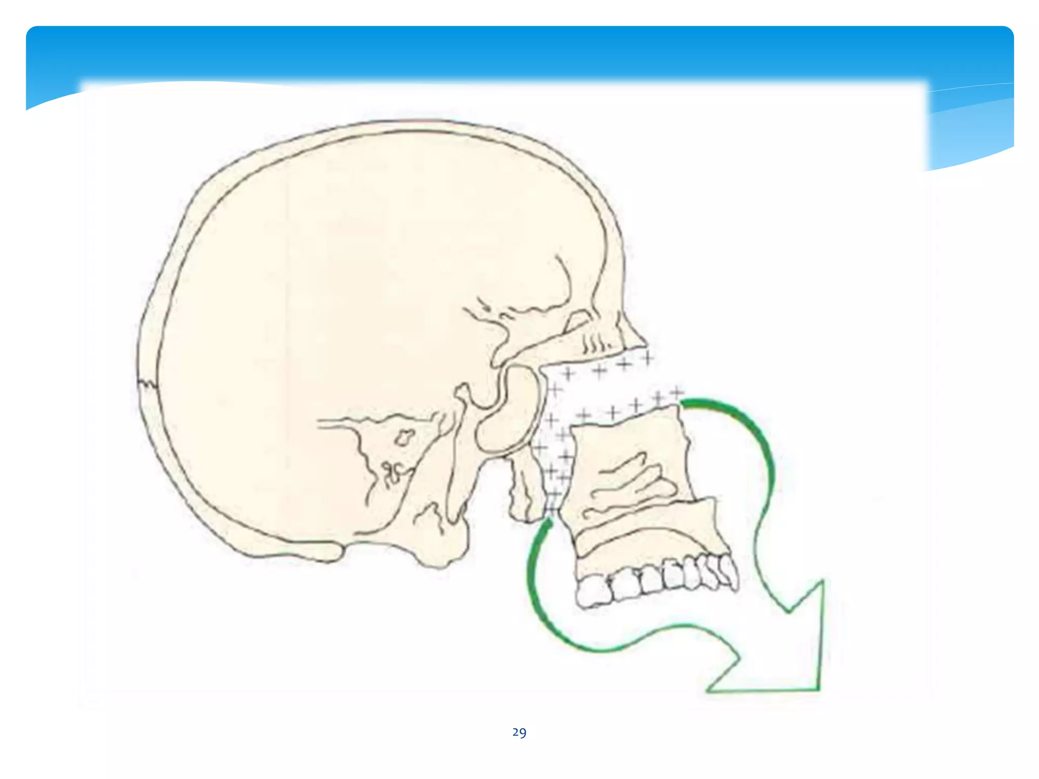 Post natal development of cranial base, maxilla and mandible | PPTX