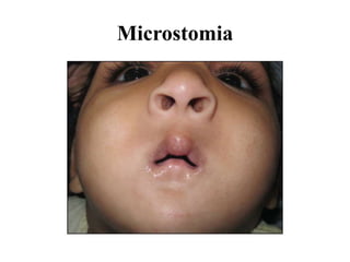 Postnatal growth of maxilla | PPTX