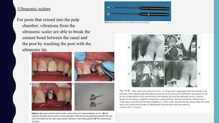 post n core. in prosthodontics and dental science | PPTX