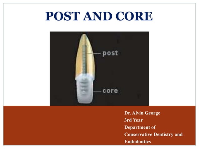 PostNdCore classification types n new trends | PPTX | Dental Health | Diseases and Conditions