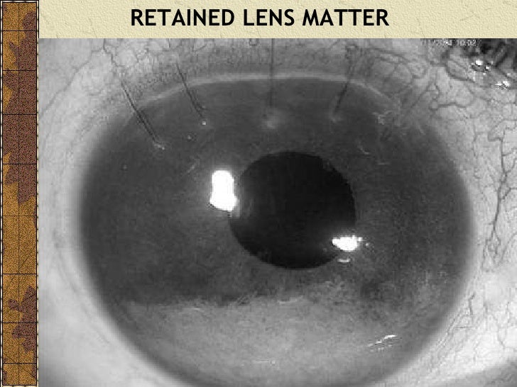 CATARACT SURGERY COMPLICATIONS