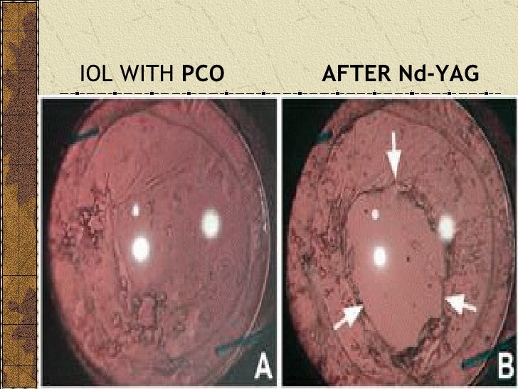 CATARACT SURGERY COMPLICATIONS