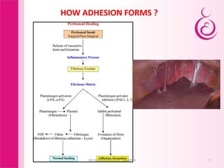 Postoperative adhesions by dr alka mukherjee nagpur m.s. | PPTX