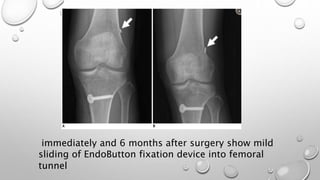 Post operative assessment of acl reconstruction | PPT