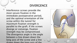 Post operative assessment of acl reconstruction | PPTX