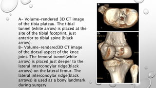 Post operative assessment of acl reconstruction | PPT