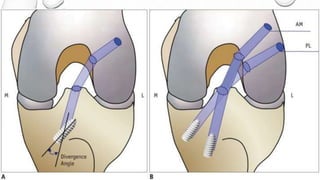 Post operative assessment of acl reconstruction | PPT