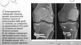 Post operative assessment of acl reconstruction | PPT