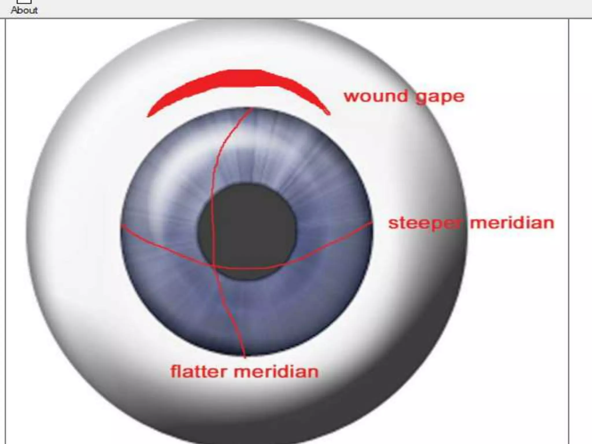 Post operative astigmatism | PPTX