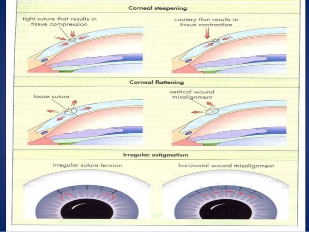 Post operative astigmatism