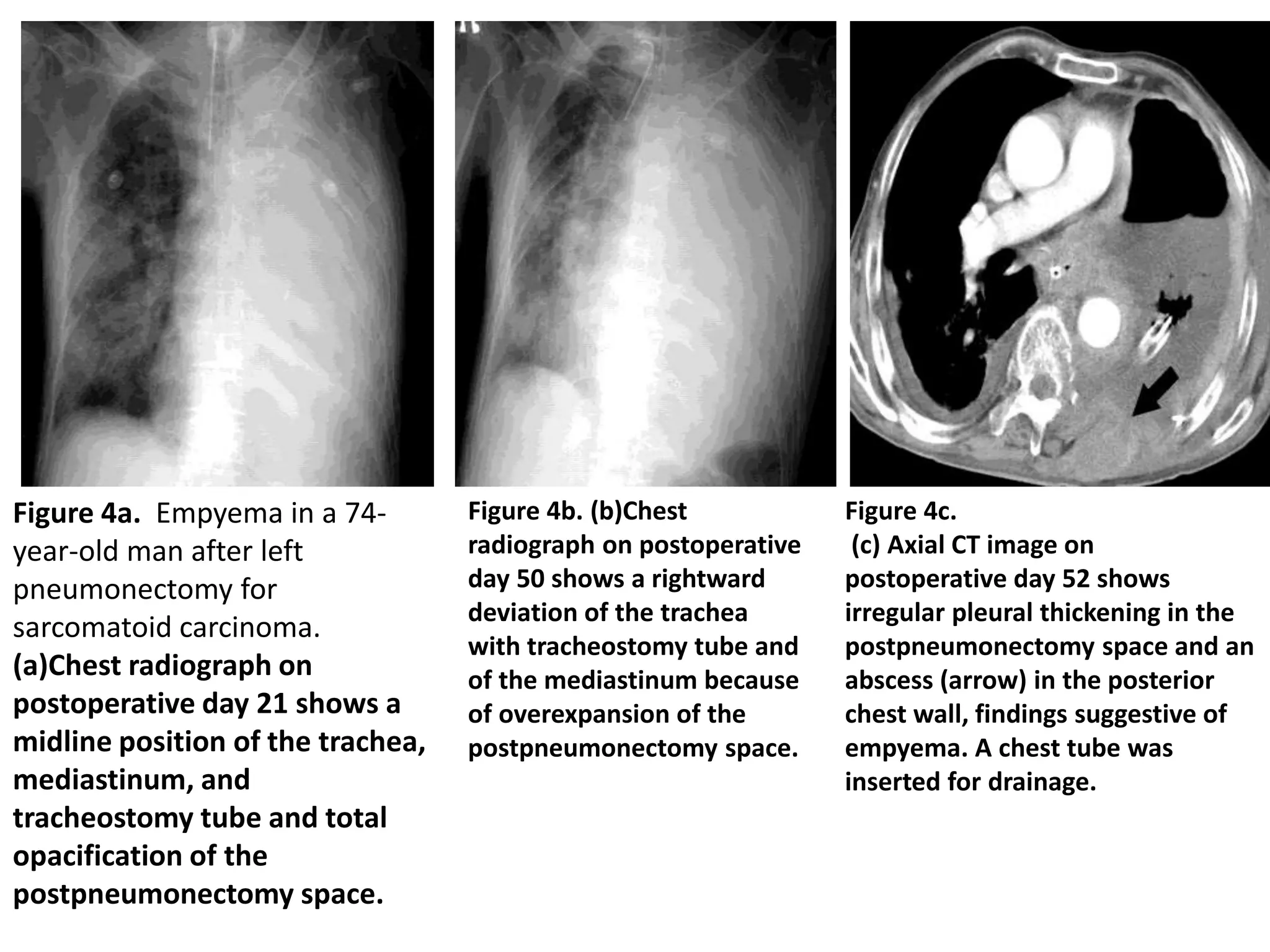 Post operative chest imaging | PPTX
