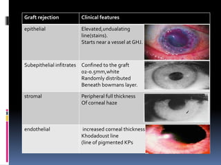 Postoperative complication of penetrating keratoplasty | PPTX