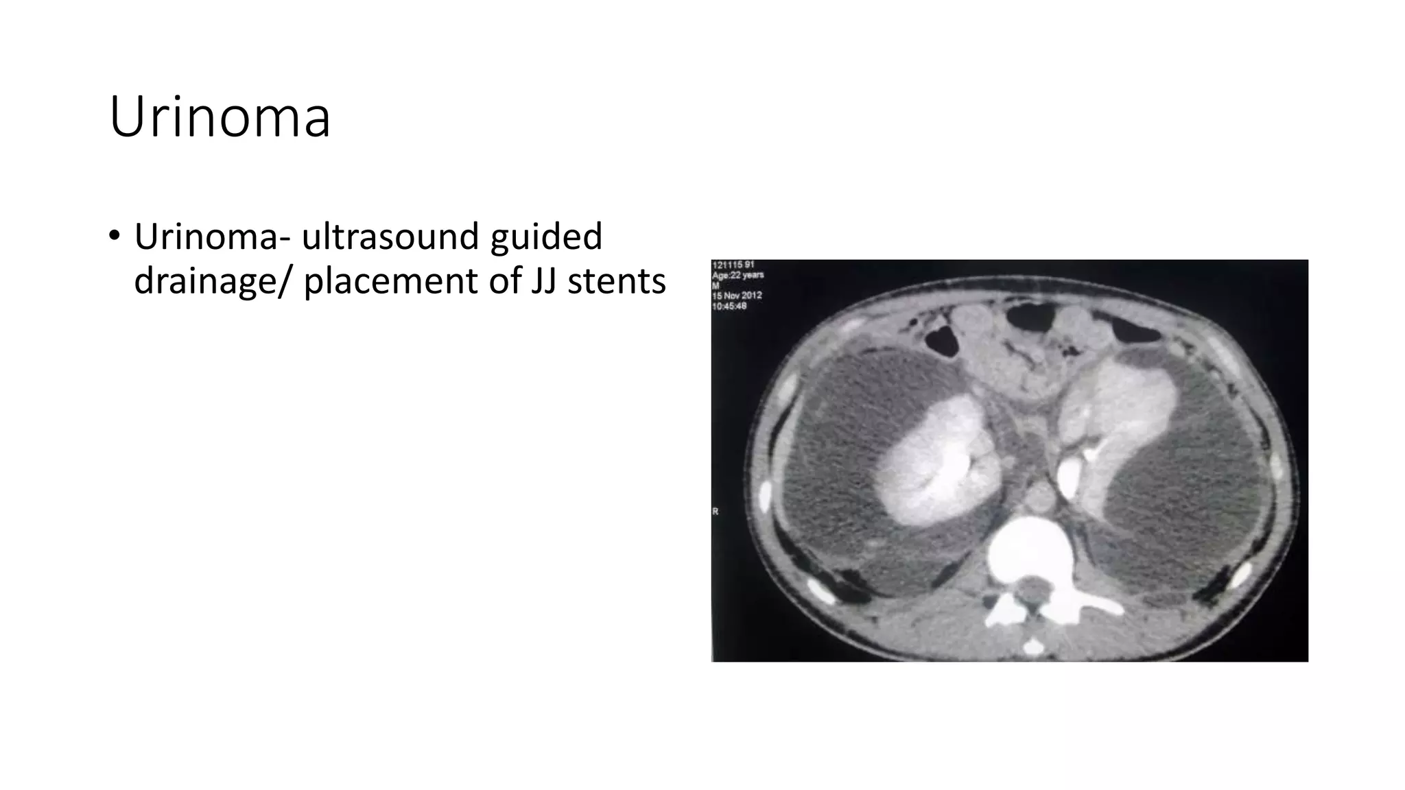 Post operative complications in urology.pptx