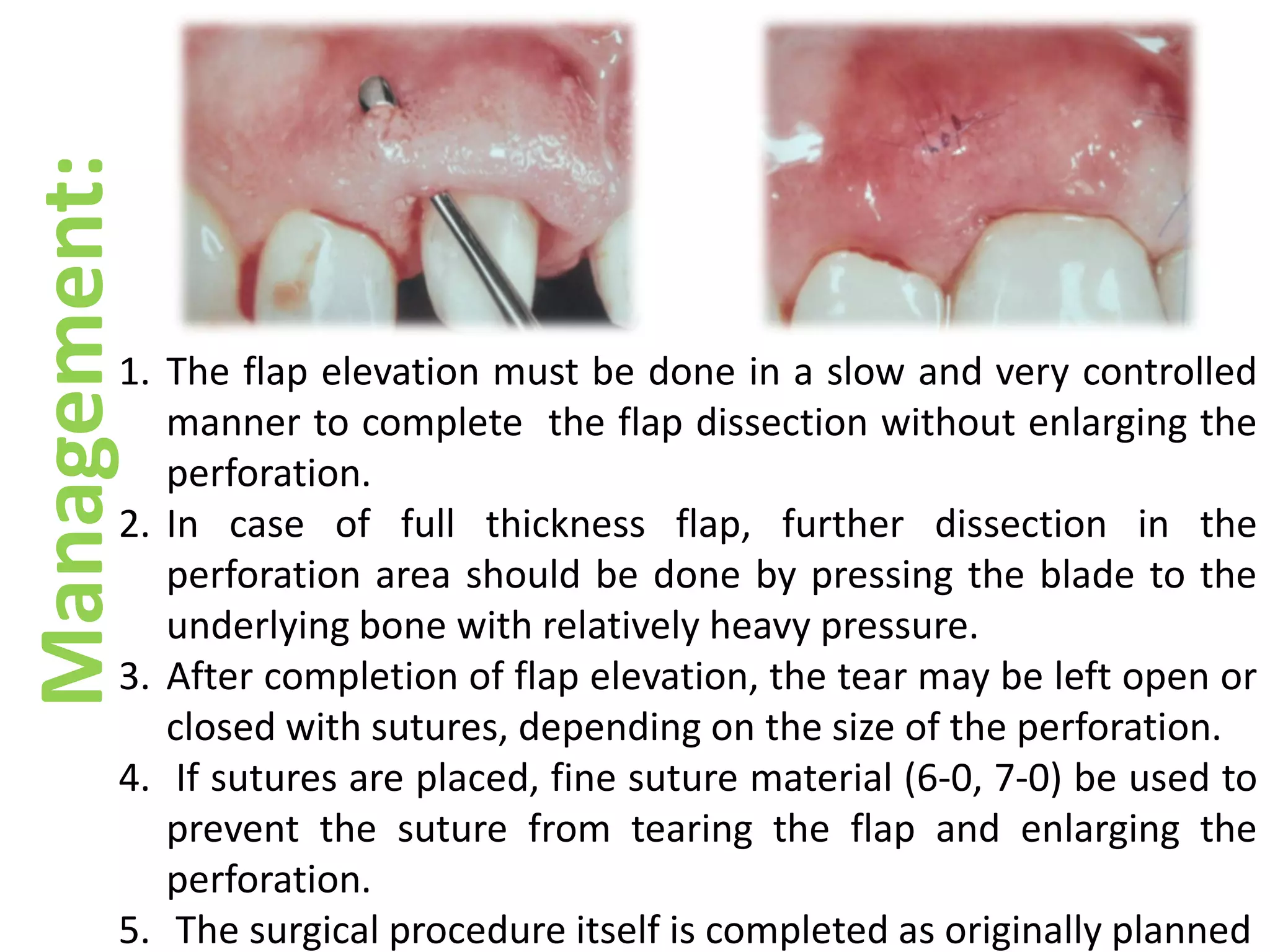 Post operative complications of periodontal surgery | PDF