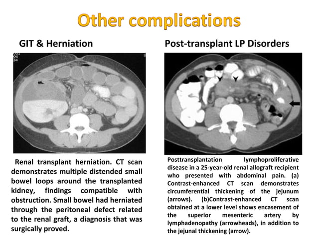 Post operative complications of renal transplant | PPT | Blood ...