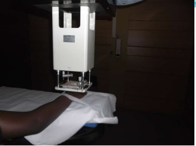 Post operative electron beam therapy for keloids by loreh peter | PPTX