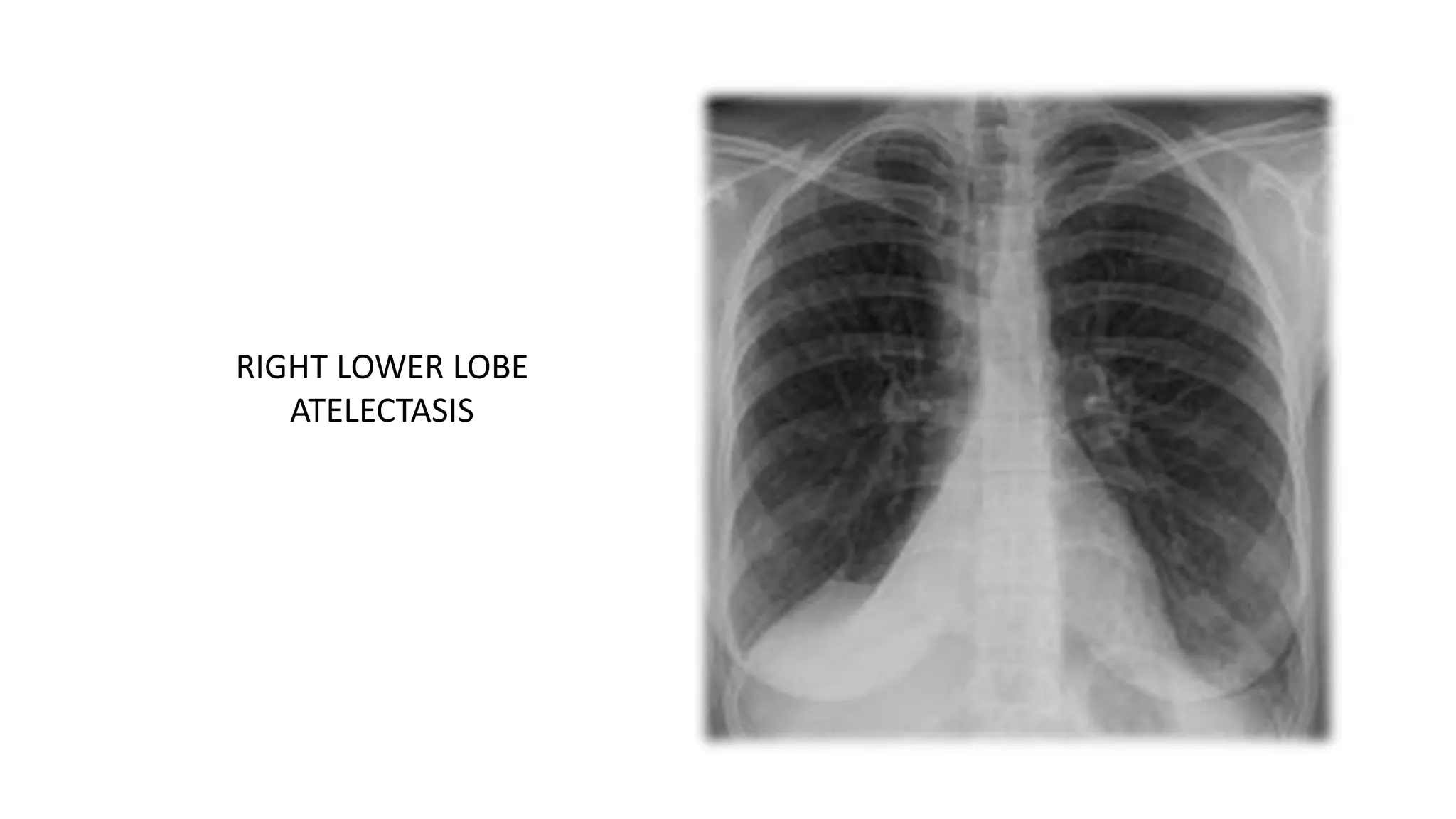 Post operative fever | PPTX