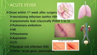 POST OPERATIVE FEVER.pptx