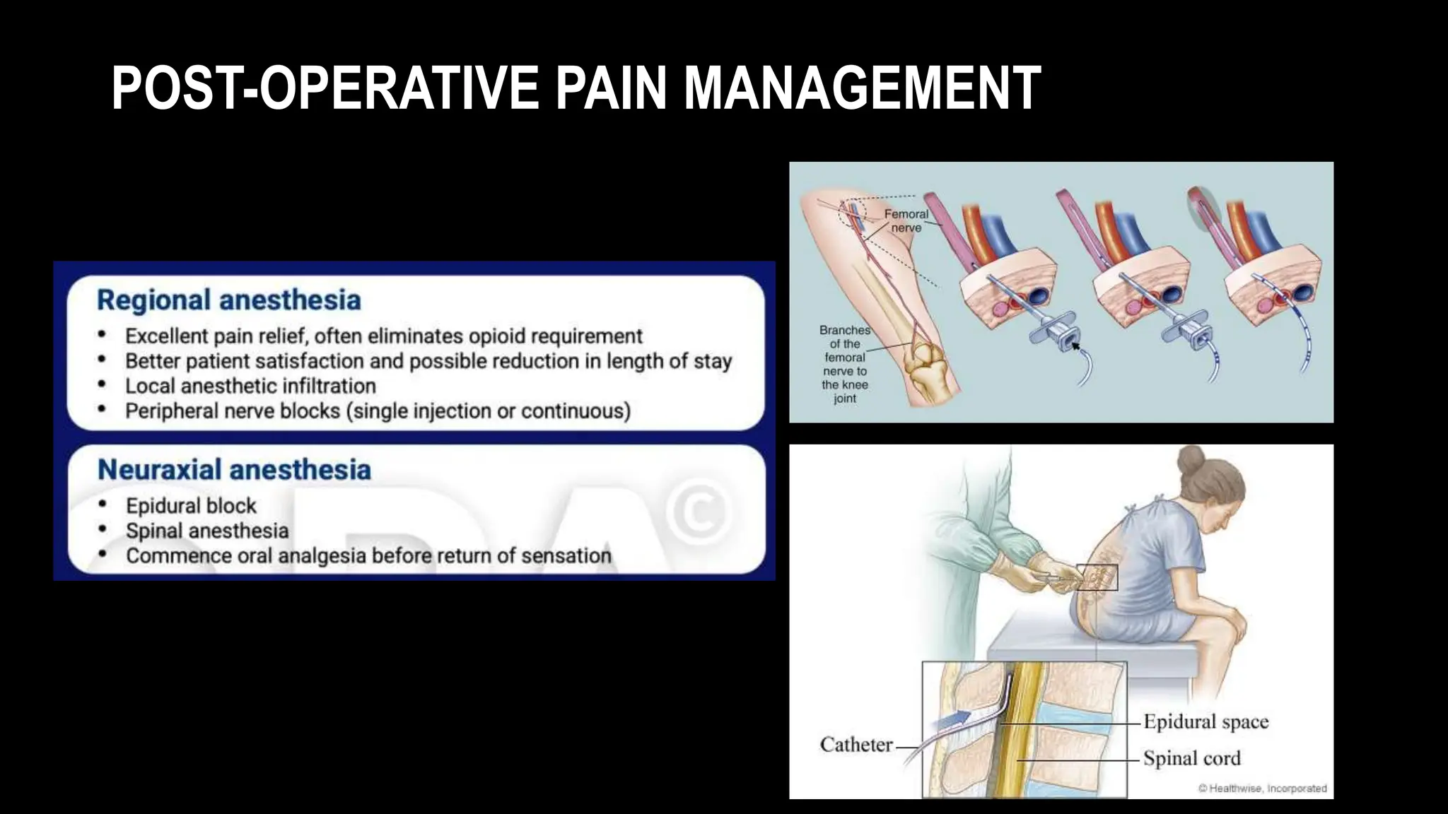 Postoperative pain management for Nurses | PPTX