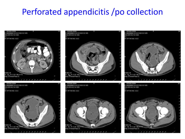 Postoperative peritonitis after elective surgery | PPTX