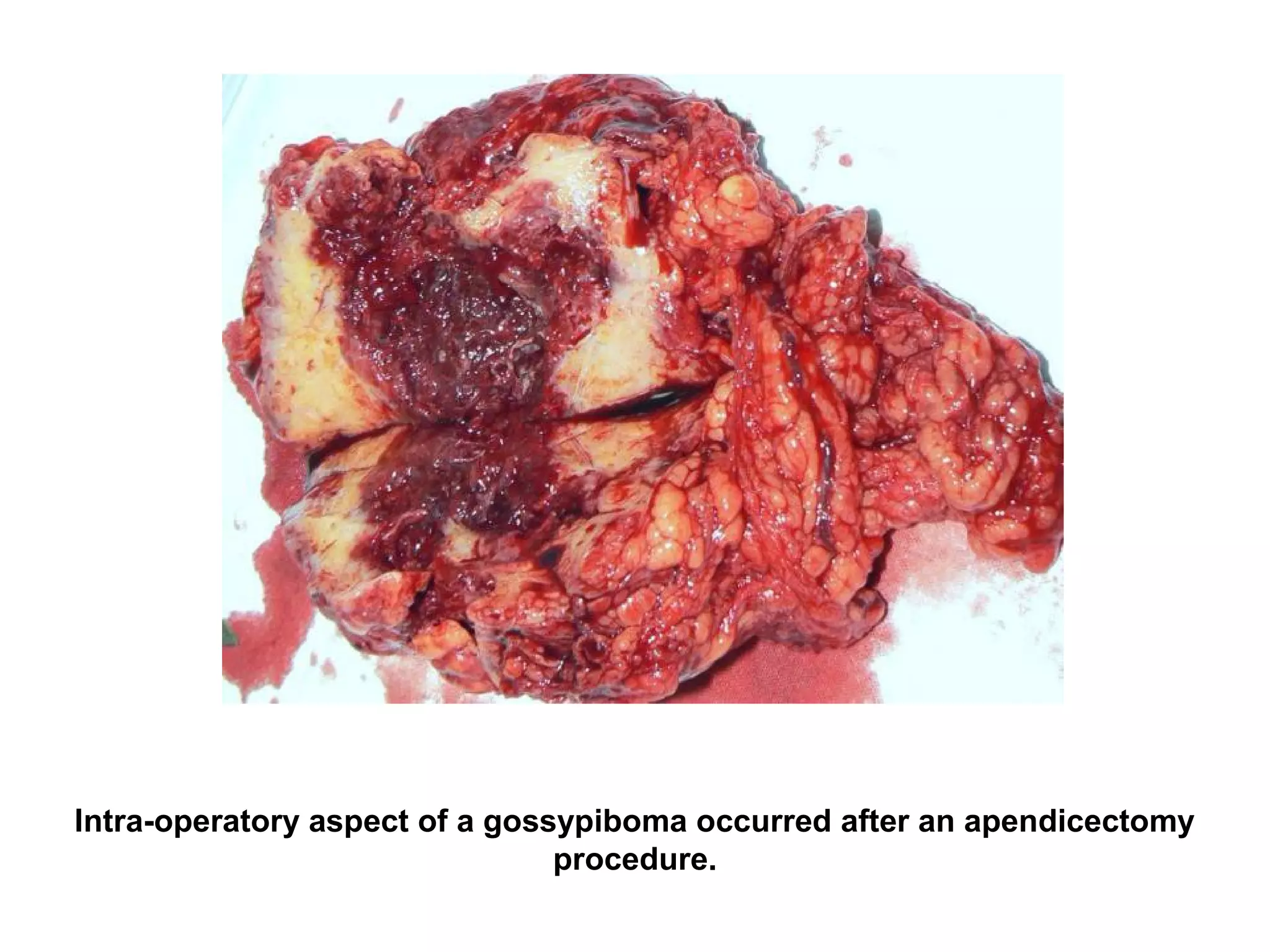 Postoperative retained foreign bodies | PDF | Digestive Disorders ...
