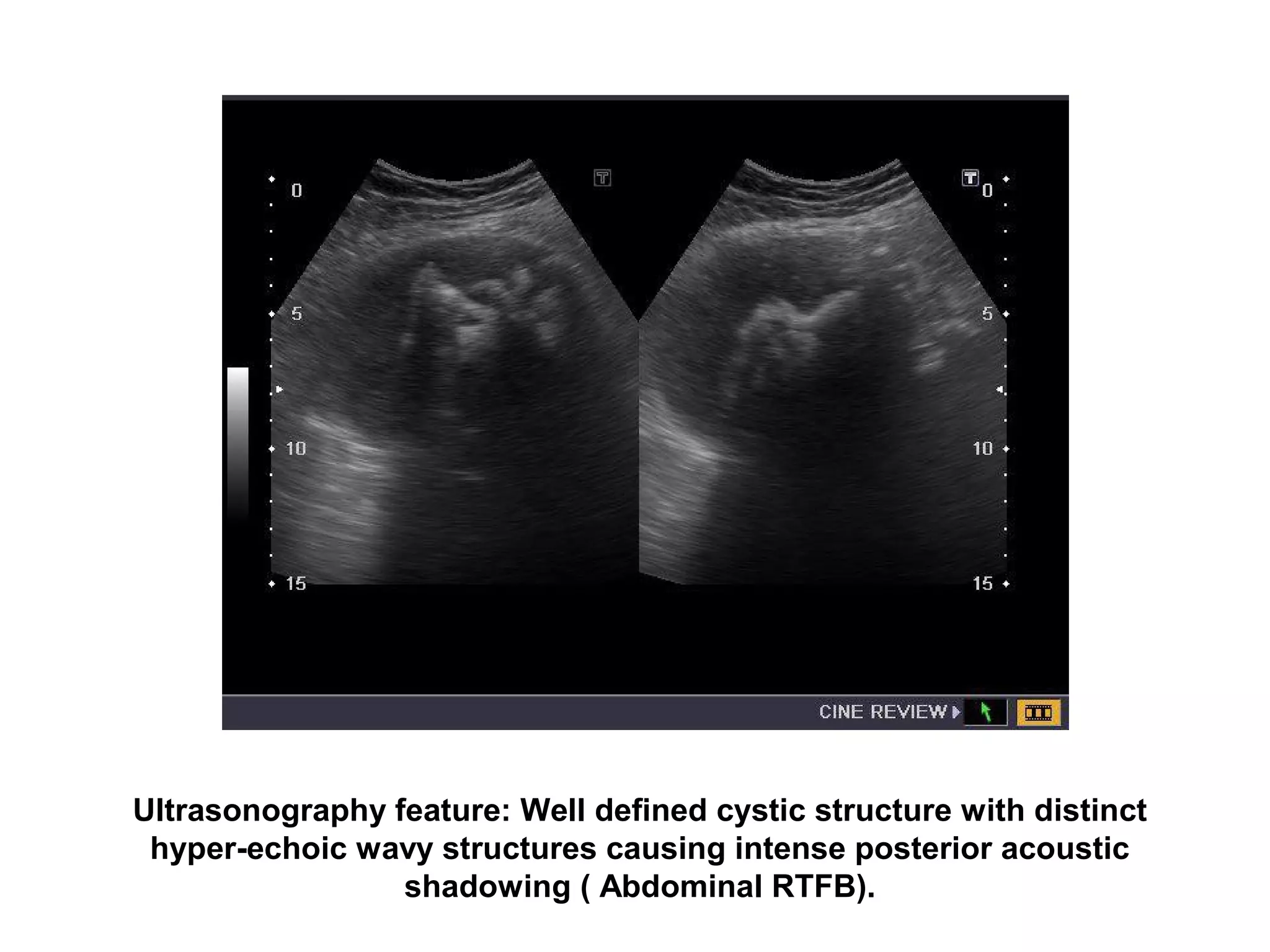 Postoperative retained foreign bodies | PDF | Digestive Disorders ...