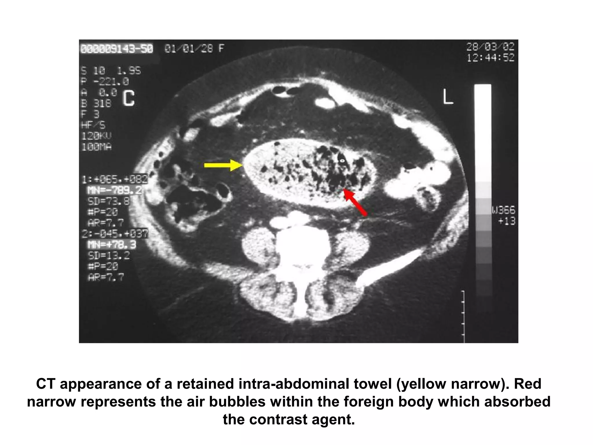 Postoperative retained foreign bodies | PDF | Digestive Disorders ...