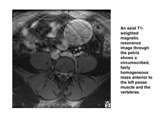 Postoperative retained foreign bodies | PDF | Digestive Disorders ...