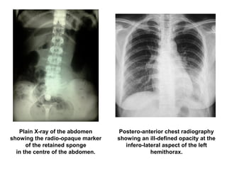 Postoperative retained foreign bodies | PDF | Digestive Disorders ...