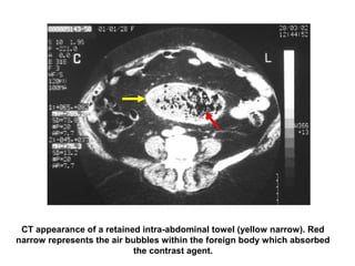 Postoperative retained foreign bodies | PDF