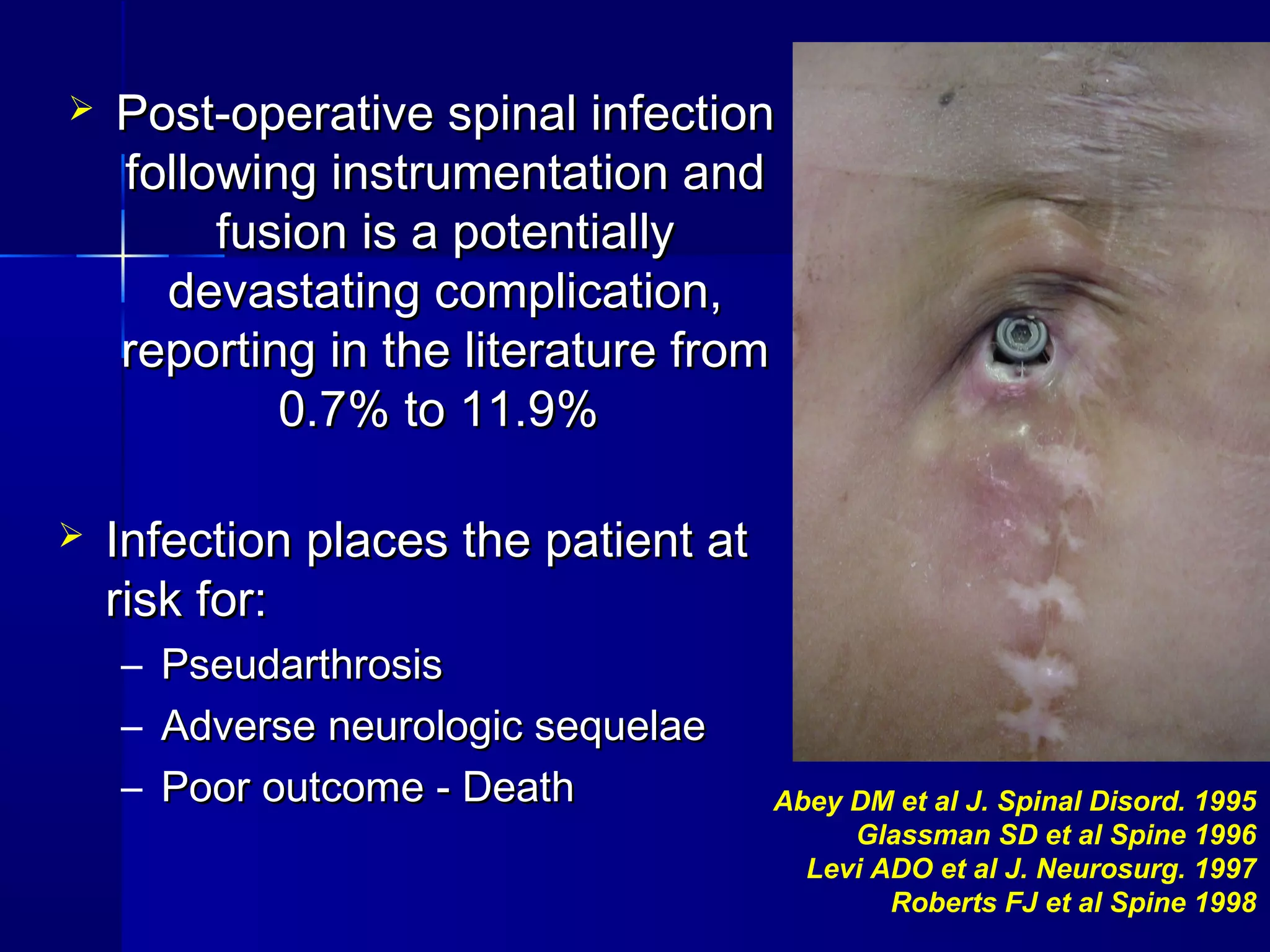 Late Post-operative Spinal Infections | PPT