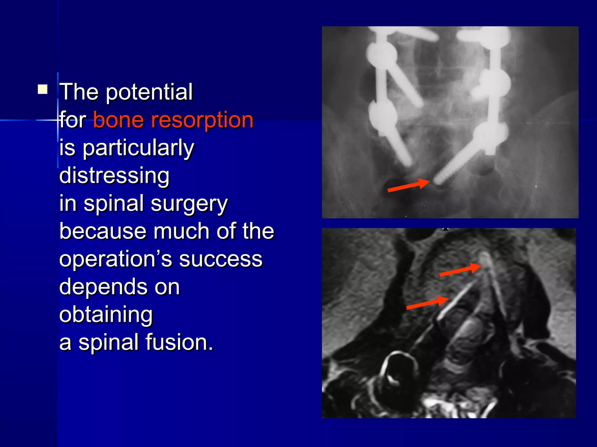 Late Post-operative Spinal Infections | PPT