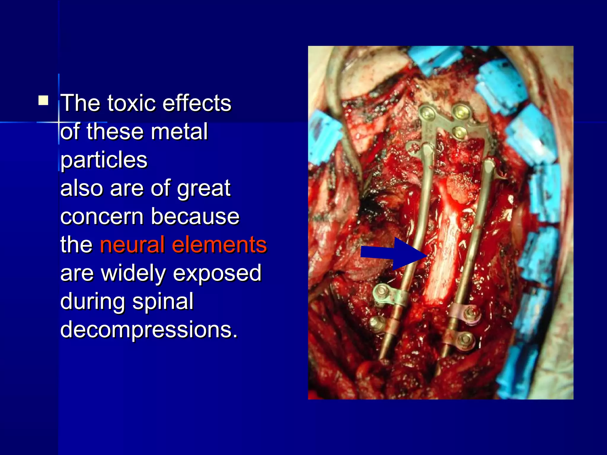 Late Post-operative Spinal Infections | PPT