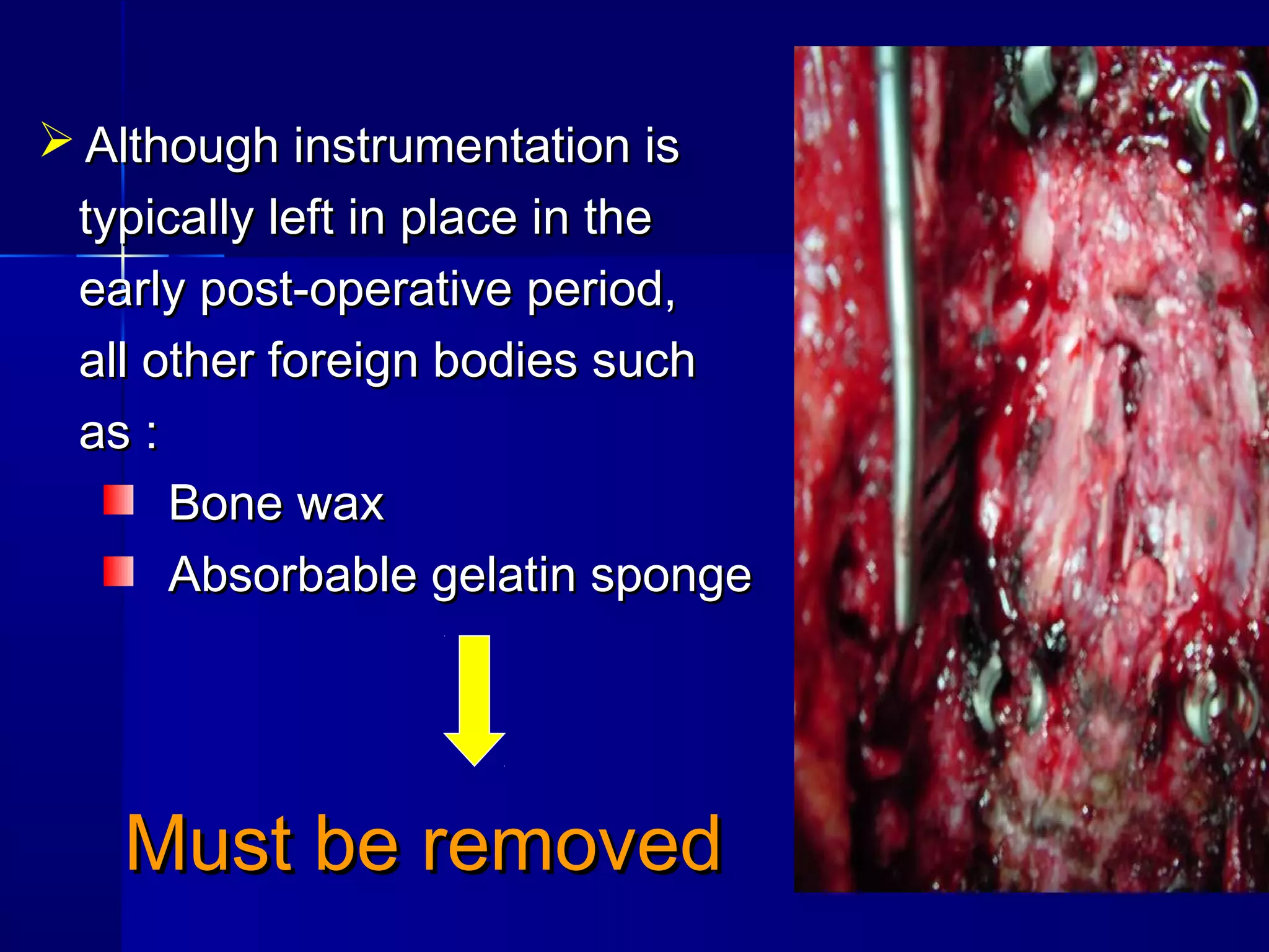 Late Post-operative Spinal Infections | PPT